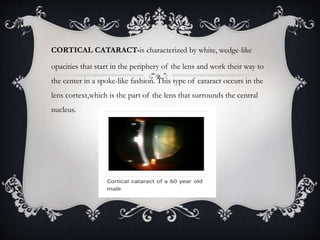 CATARACTS.pptx