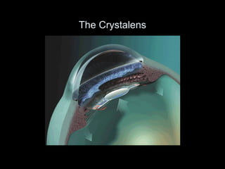 Cataracts and premium iol's | PPT