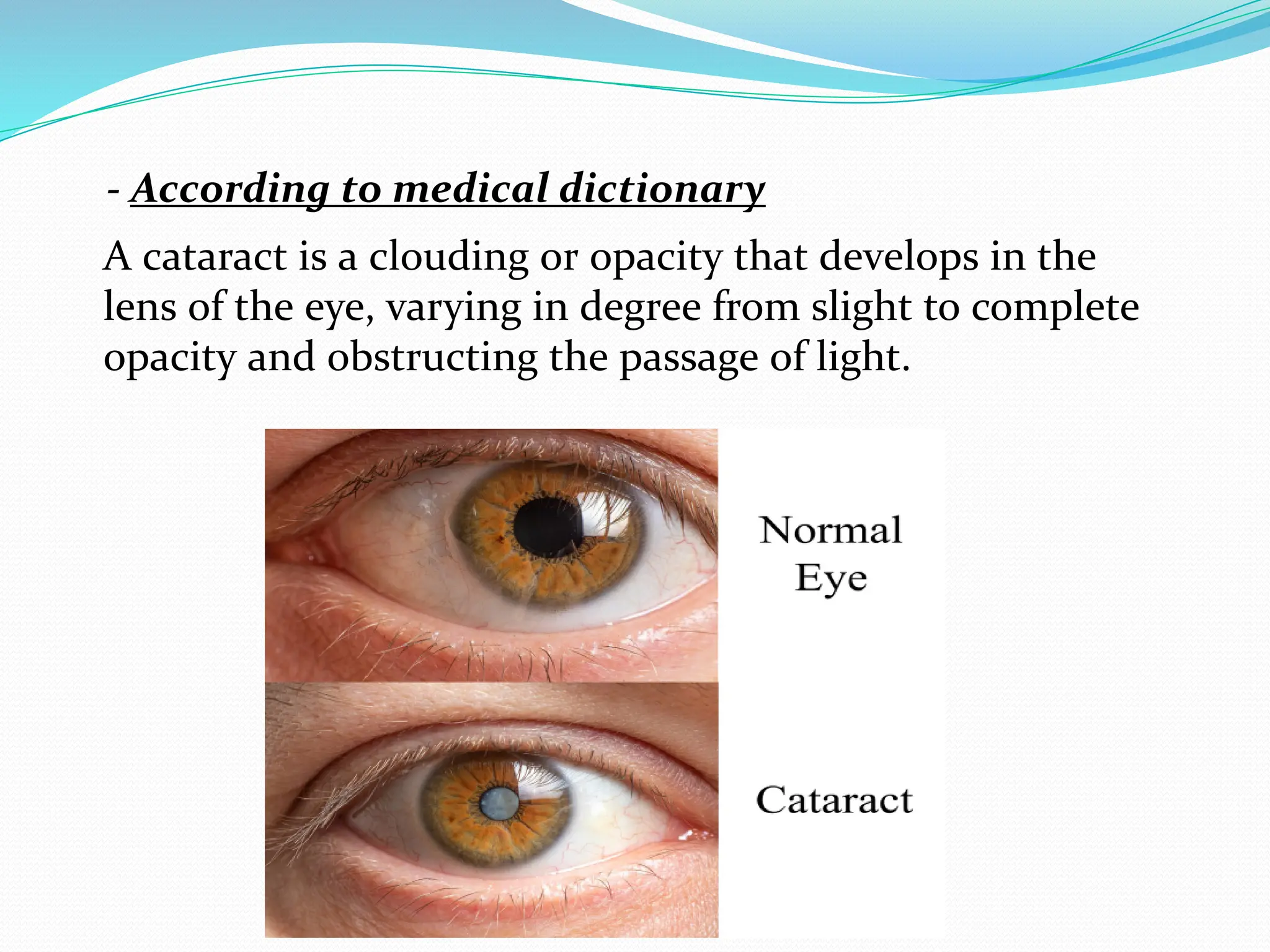 CATARACT SEMINAR PRESENTATION WITH PATHOPHYSIOLOGY | PDF