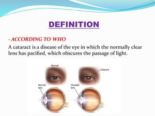 CATARACT SEMINAR PRESENTATION WITH PATHOPHYSIOLOGY | PDF