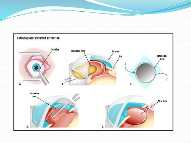 CATARACT SEMINAR PRESENTATION WITH PATHOPHYSIOLOGY | PDF