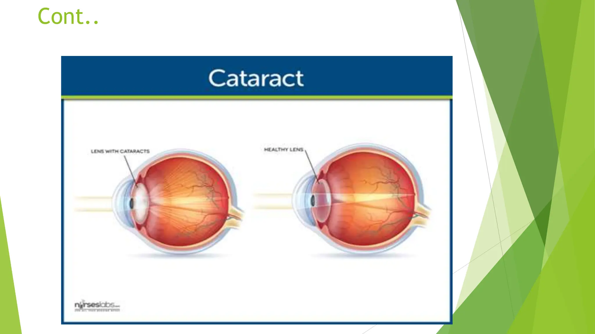 CATARACTS presentation_med surg085249.pptx