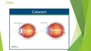 CATARACTS presentation_med surg085249.pptx