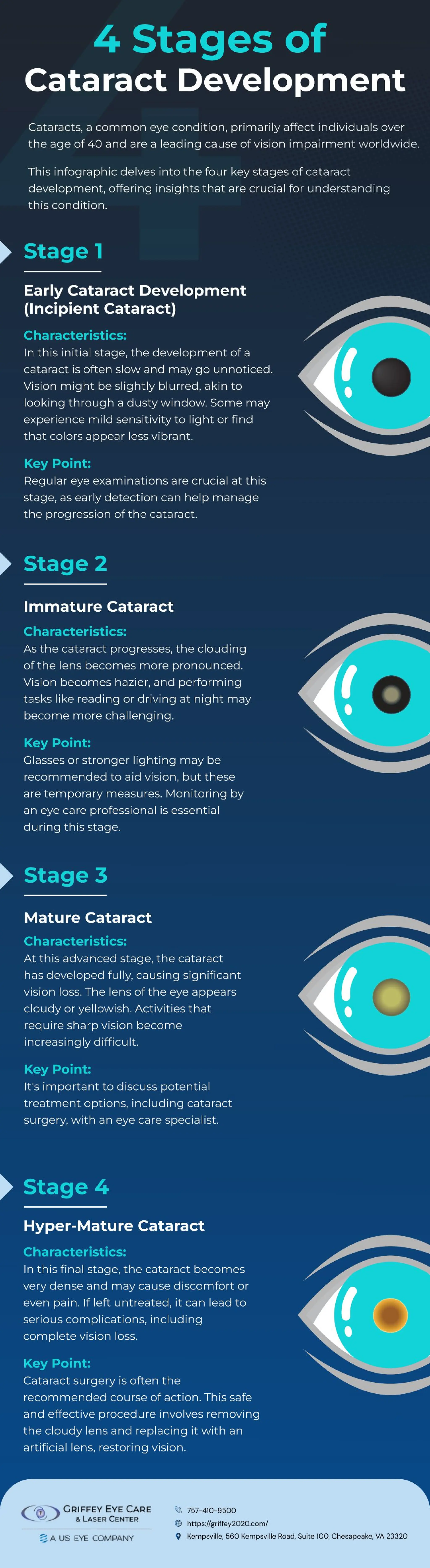 4 Stages of Cataract Development | PDF