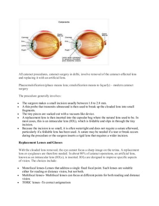 Cataract surgery | PDF