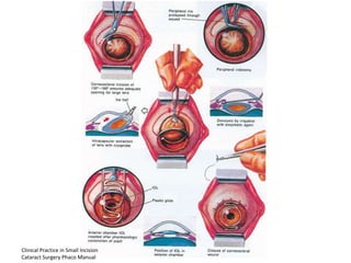cataract surgery.pptx