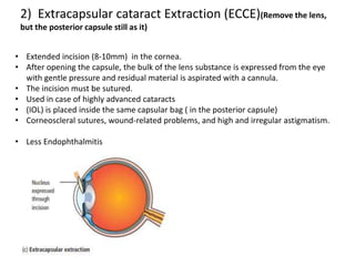 cataract surgery.pptx