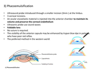 cataract surgery.pptx