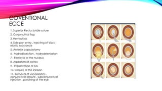 Cataract Surgery . IOL s.pptx types of IOLs | PPTX