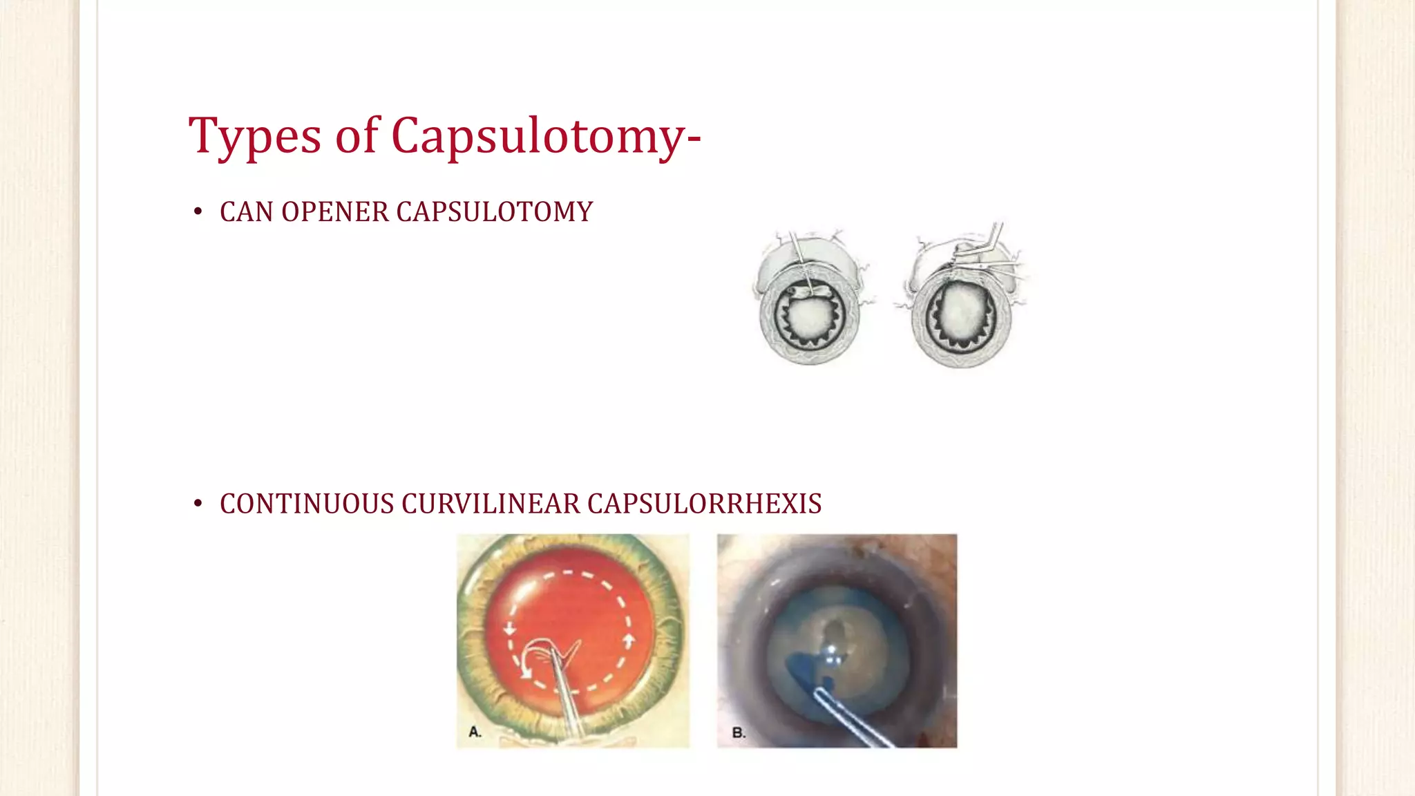 Cataract surgery past present future | PPTX