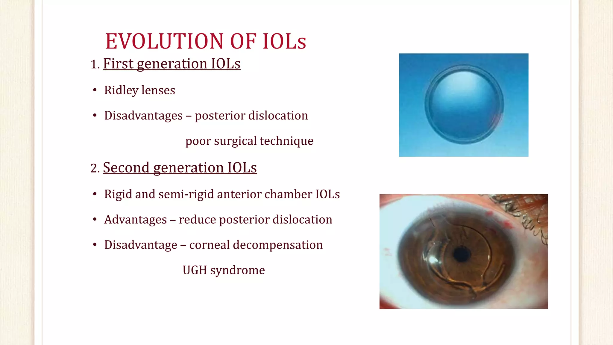 Cataract surgery past present future | PPTX