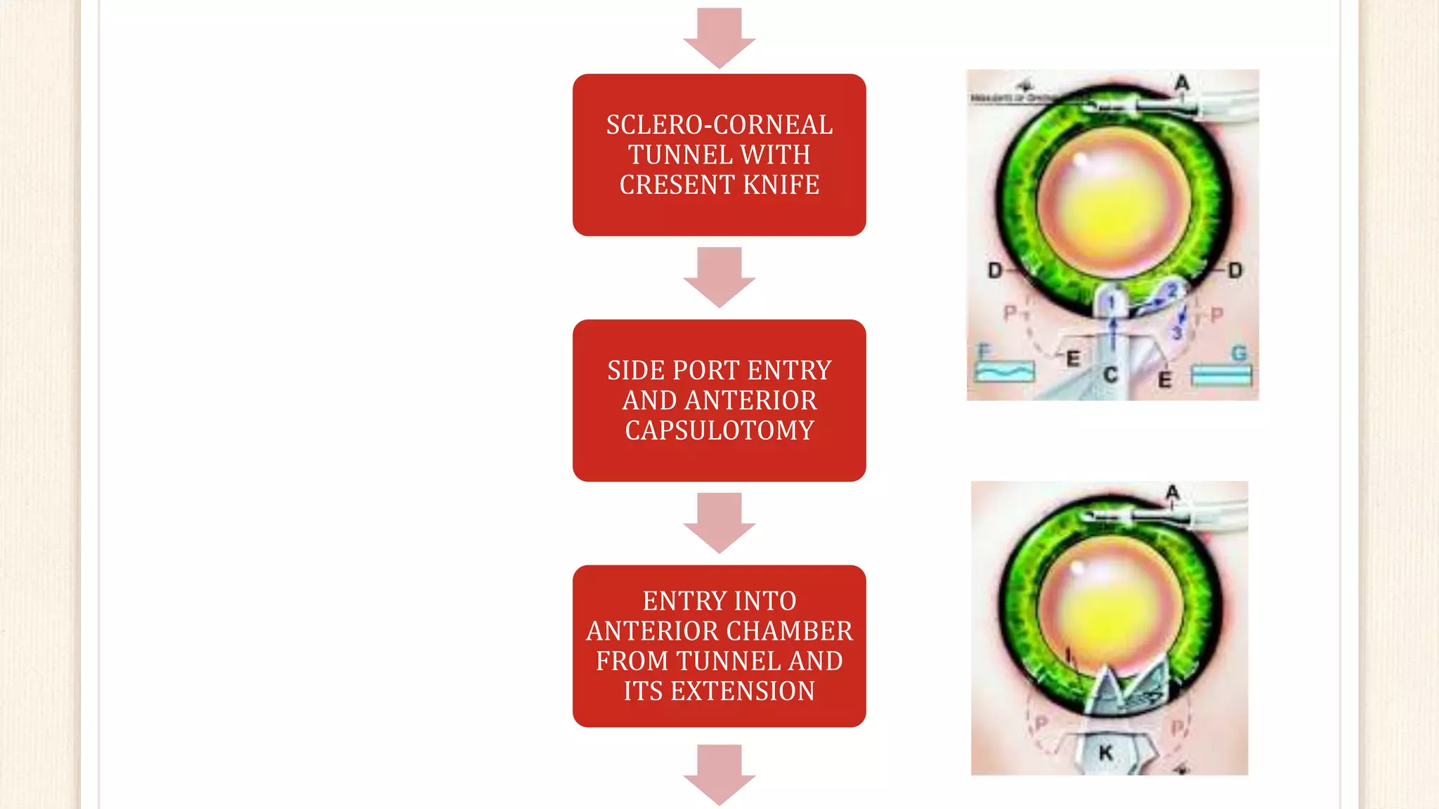 Cataract surgery past present future | PPTX