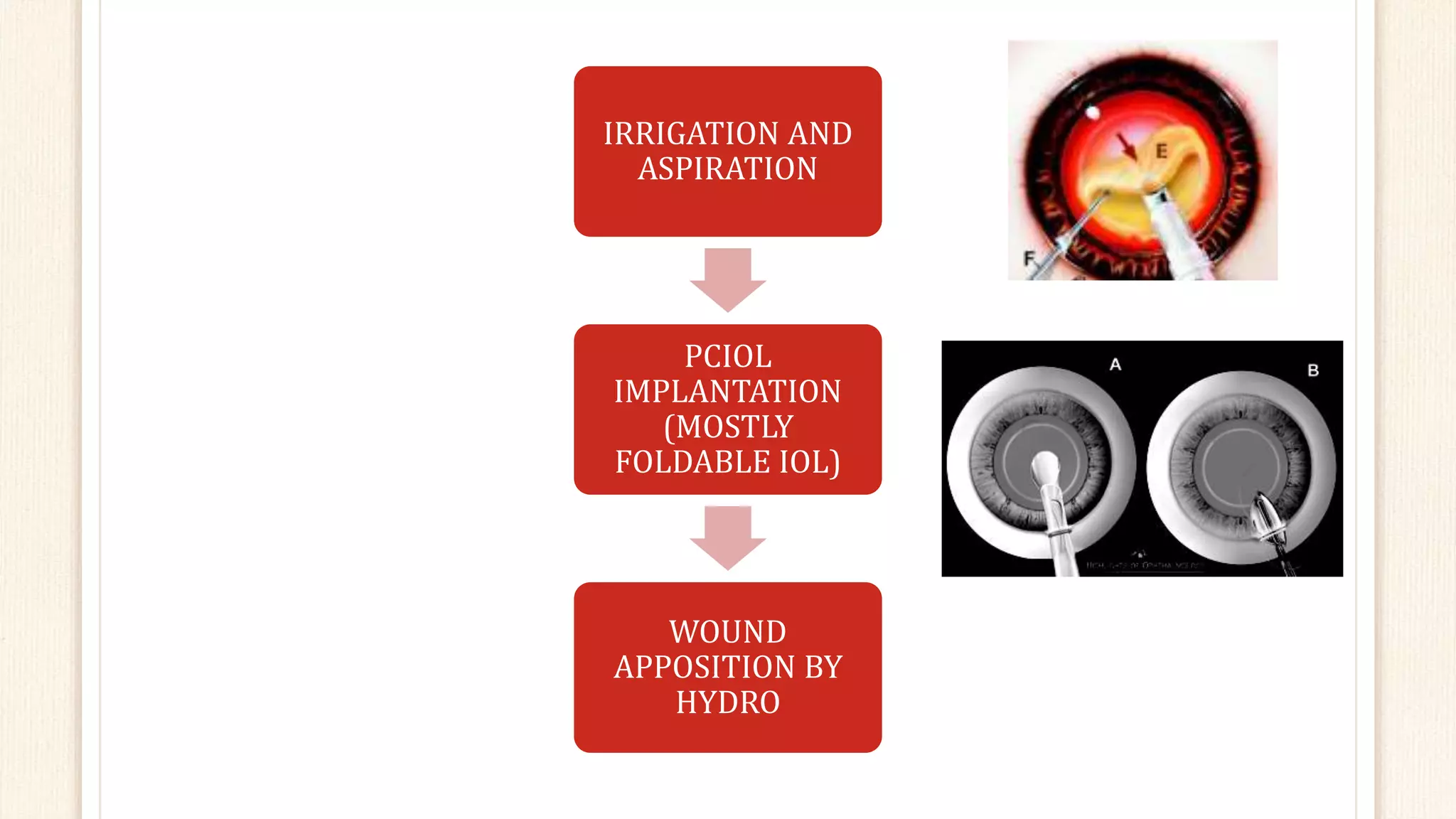 Cataract surgery past present future | PPTX