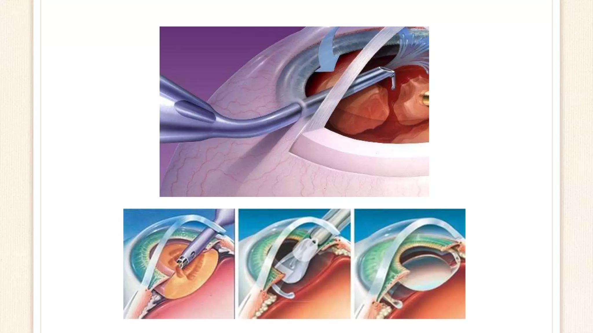 Cataract surgery past present future | PPTX