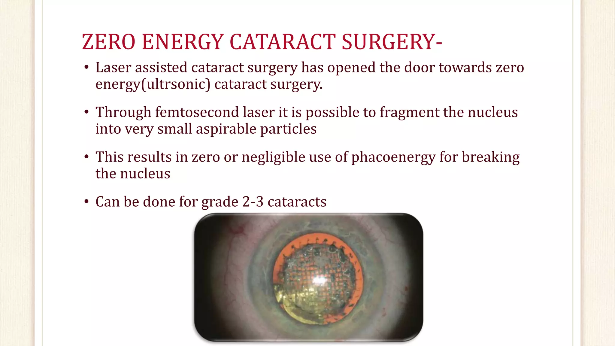 Cataract surgery past present future | PPTX