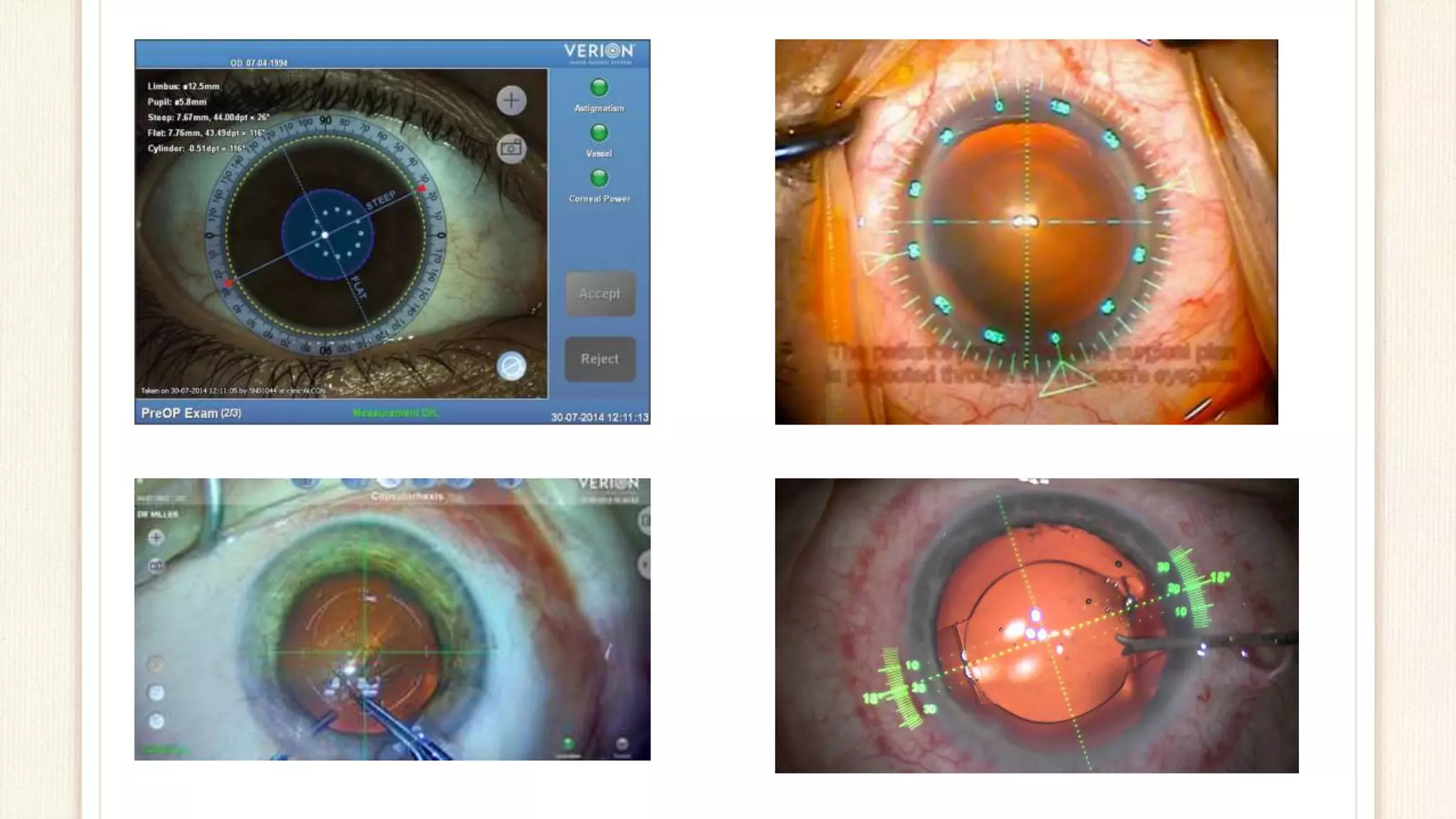 Cataract surgery past present future | PPTX