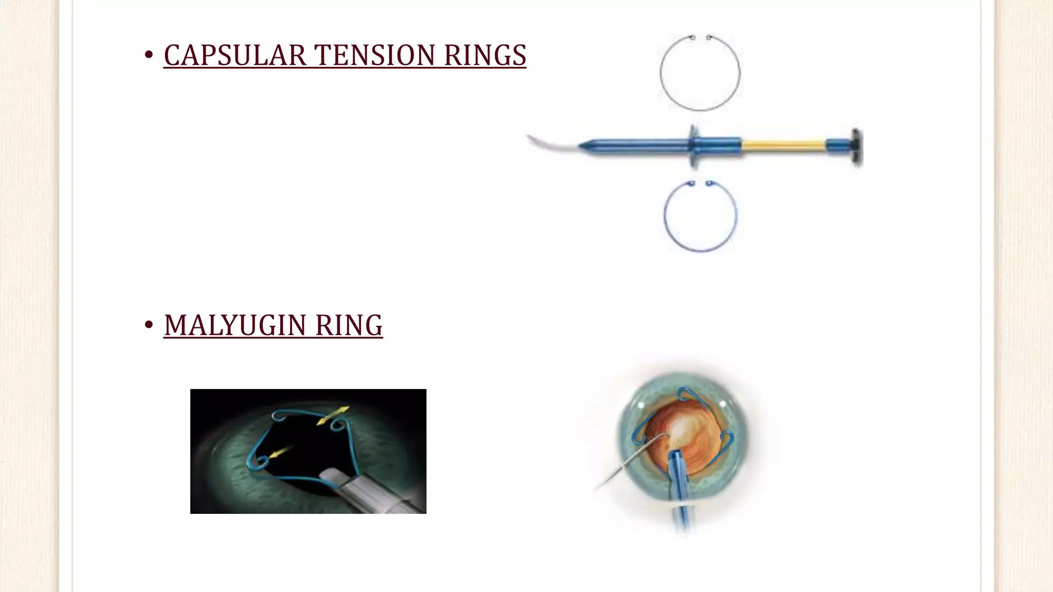 Cataract surgery past present future | PPTX