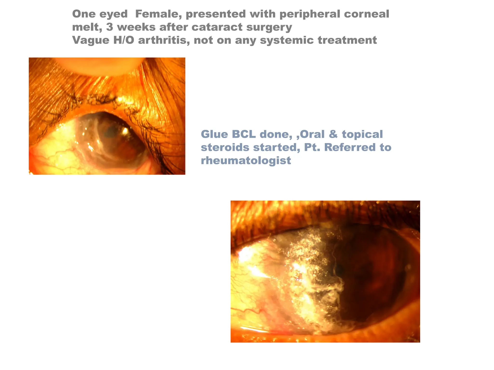 Cataract surgery in presence of Corneal morbidity- 20. 3.21 .pptx