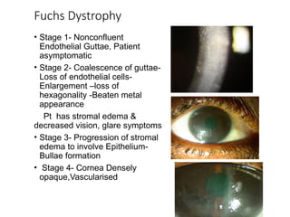Cataract surgery in presence of Corneal morbidity- 20. 3.21 .pptx
