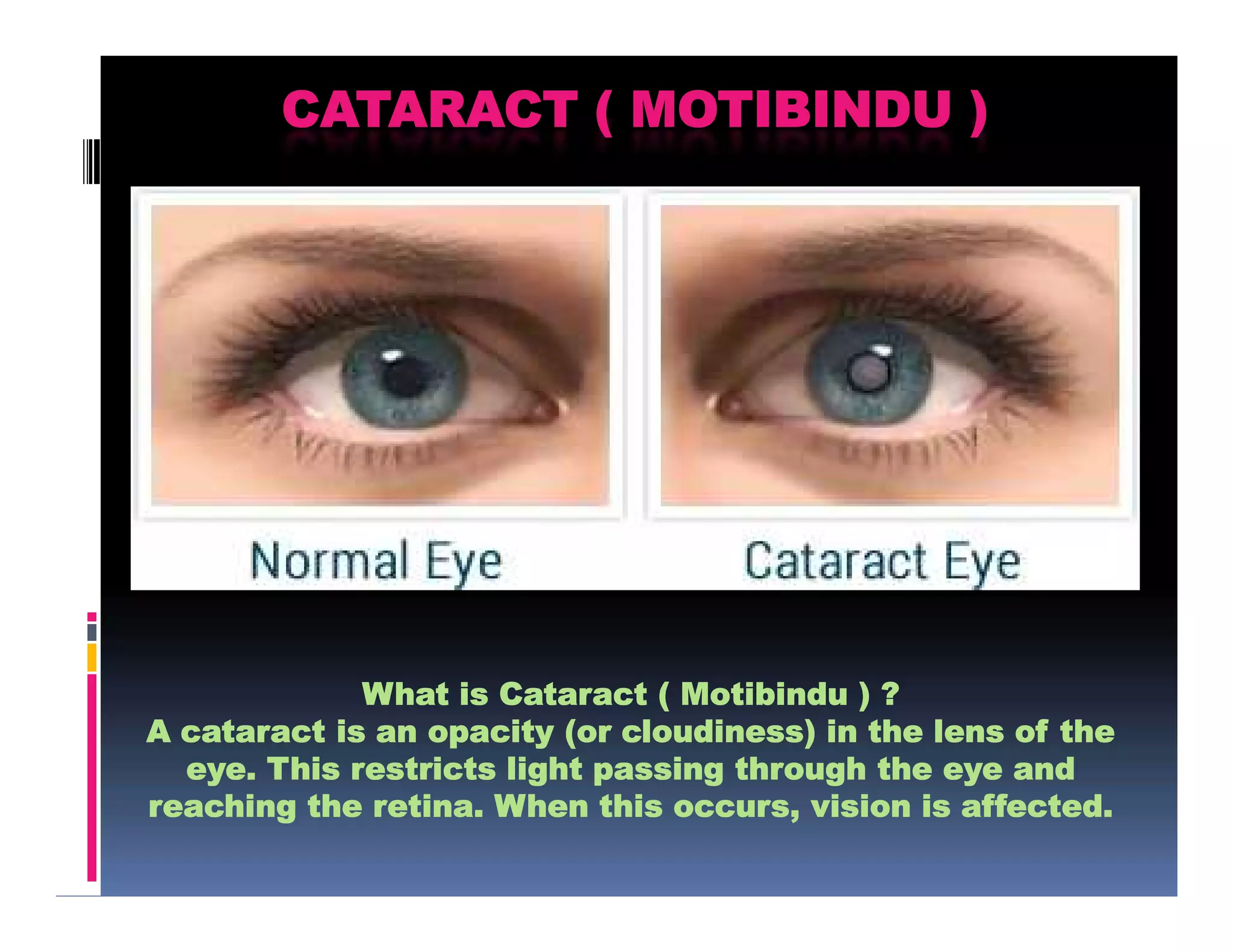 Cataract Surgery In Pune | PDF
