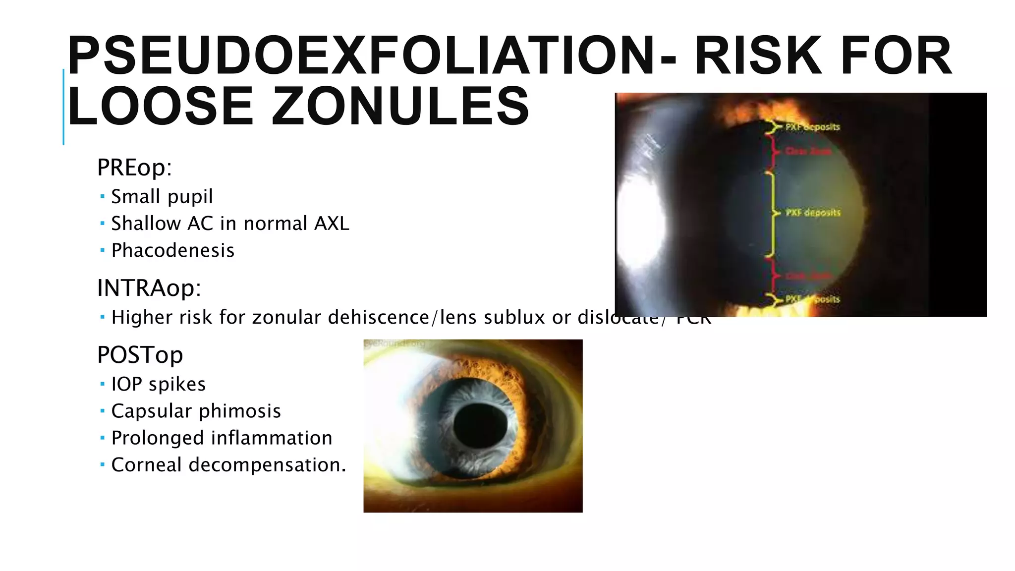 Cataract surgery in special situations | PPTX