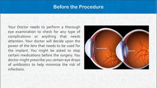 Cataract surgery ppt- Lyfboat | PPT