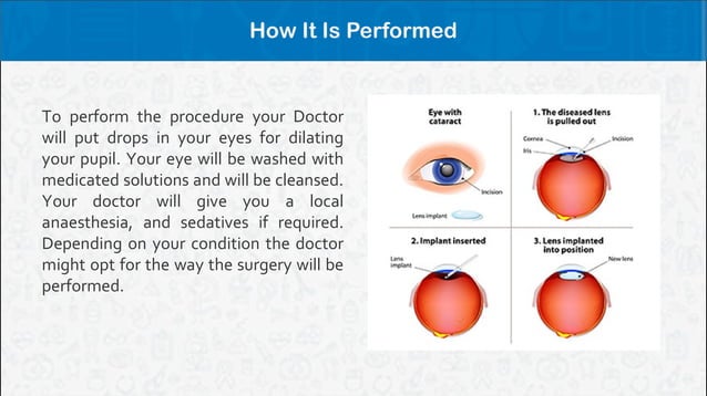 Cataract surgery ppt- Lyfboat | PPT