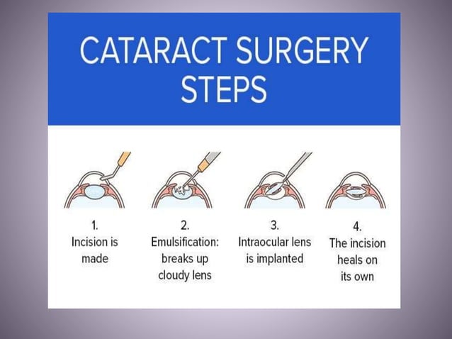 cataract surgery and procedures ppt.pptx