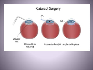 cataract surgery and procedures ppt.pptx