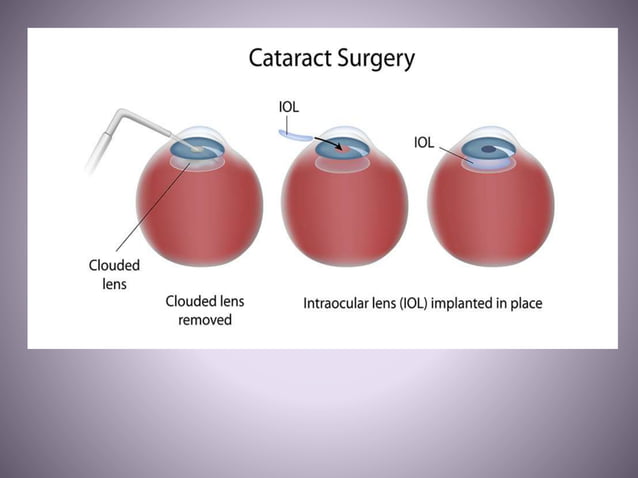 cataract surgery and procedures ppt.pptx