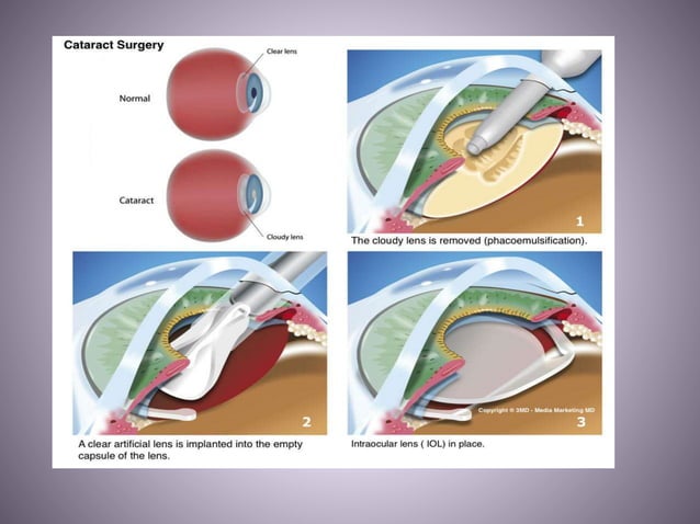 cataract surgery and procedures ppt.pptx