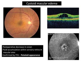 Cataract Surgery Complications for General Practitioners | PPTX
