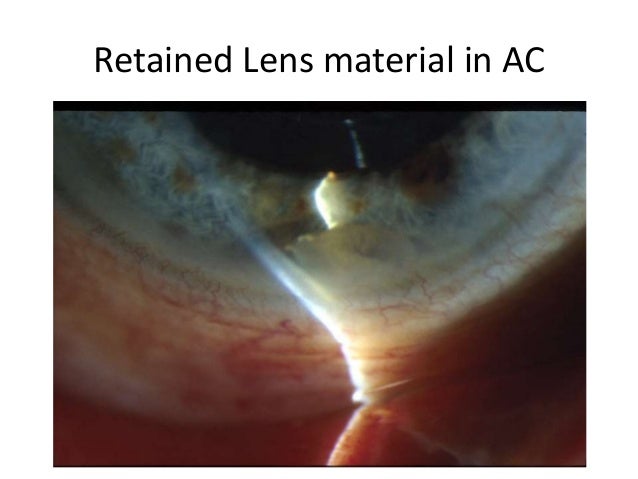 Cataract Surgery Complications for General Practitioners
