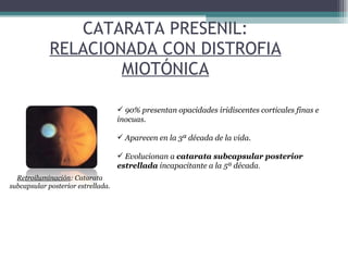 Catarata | PPT