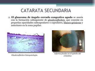 Catarata | PPT