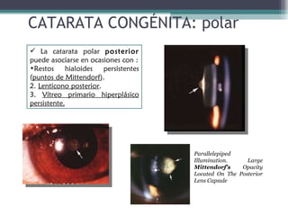 Catarata | PPT