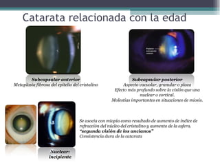 Catarata | PPT