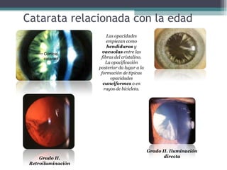 Catarata | PPT