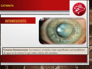 Catarata | PPT
