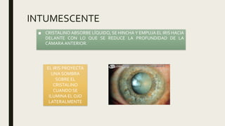 Catarata congenita | PPTX