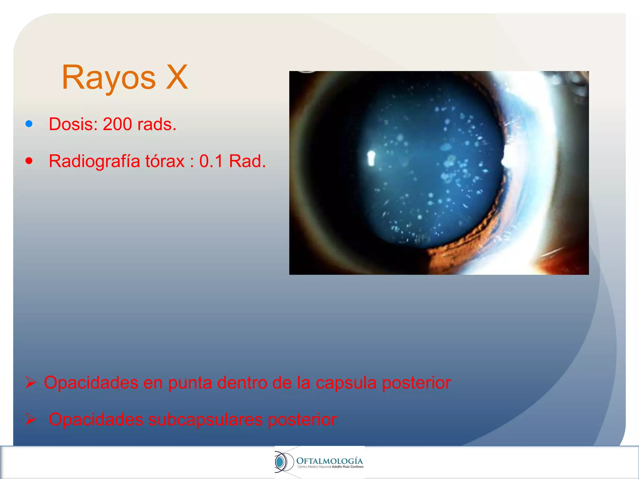 Catarata intumescente y secundaria manejo y tratamiento | PPTX