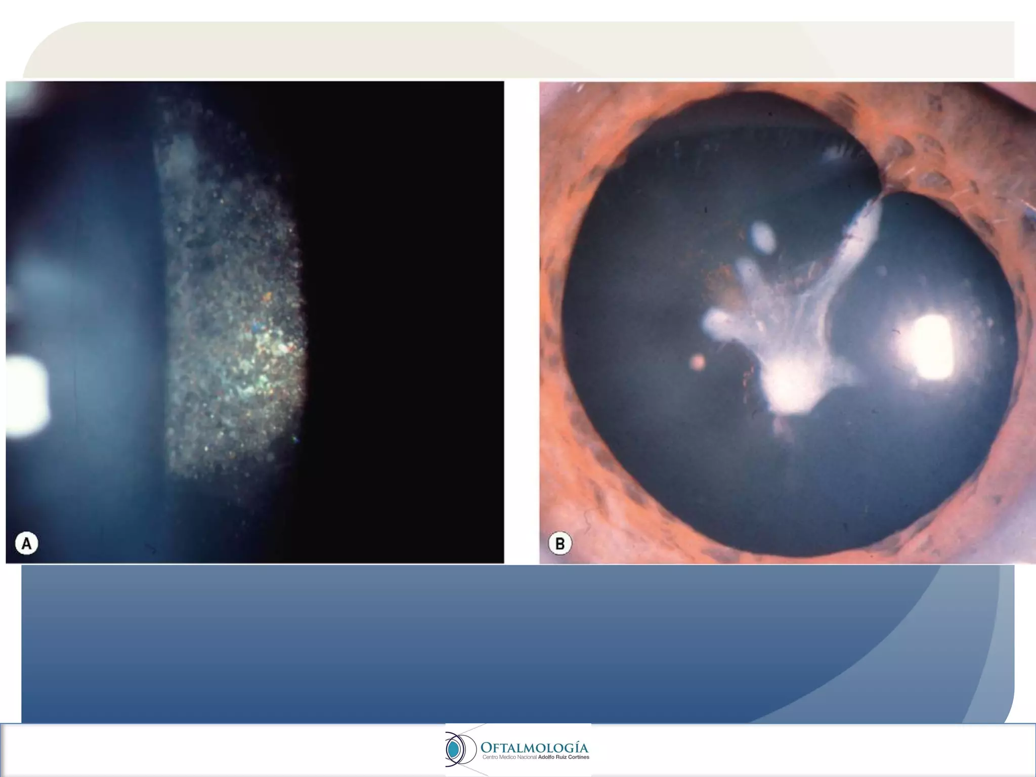 Catarata intumescente y secundaria manejo y tratamiento | PPTX