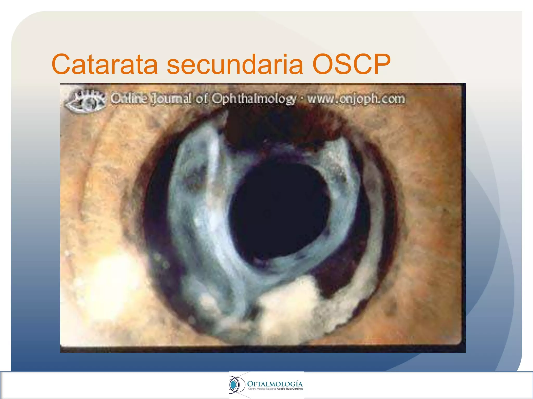 Catarata intumescente y secundaria manejo y tratamiento | PPTX