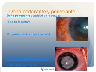 Catarata intumescente y secundaria manejo y tratamiento | PPTX