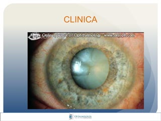Catarata intumescente y secundaria manejo y tratamiento | PPTX