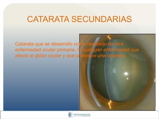 Catarata intumescente y secundaria manejo y tratamiento | PPTX