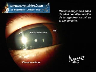 Catarata polar | PPT