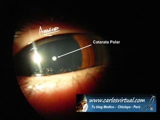Catarata polar | PPT