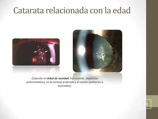 Cataratas | PPTX