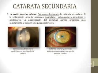 Cataratas | PPTX